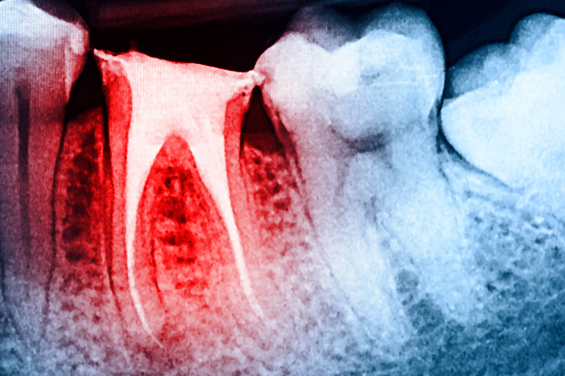 Traumatic Injuries - Woodside Endodontics