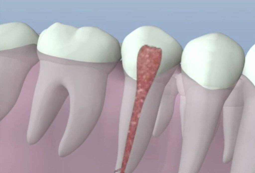 Frequently Asked Questions - Woodside Endodontics - Redwood City, CA